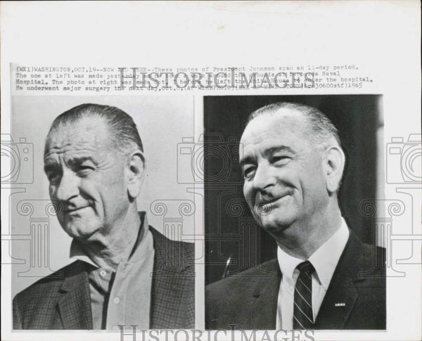 1965 Press Photo President Lyndon Johnson Before & After Surgery ...
